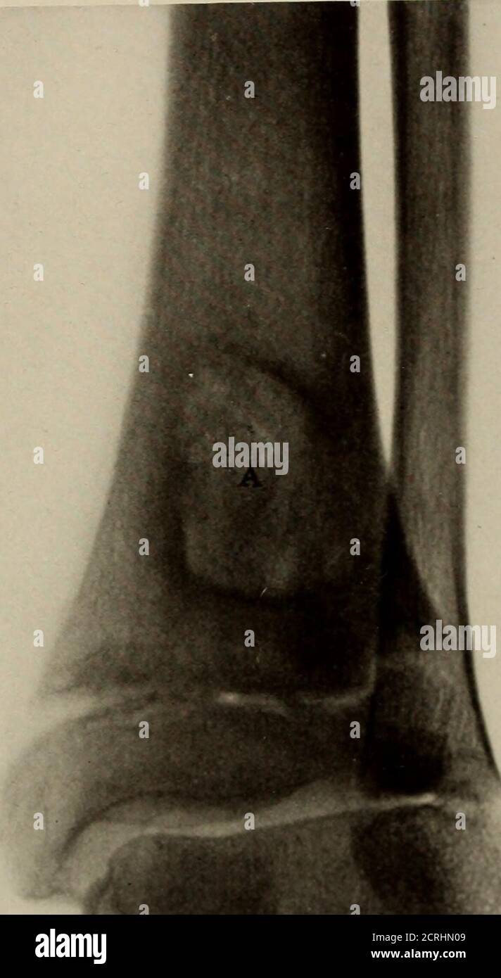 . Living anatomy and pathology; . PLATE 225.OSTEOMYELITIS OF LOWER END ...