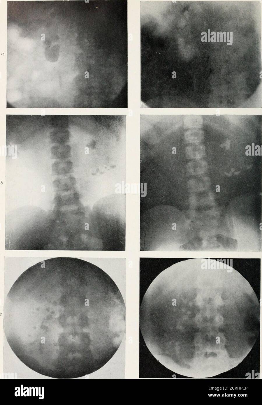 . Radiography, X-ray therapeutics and radium therapy . FlG. 183.—Stone ...