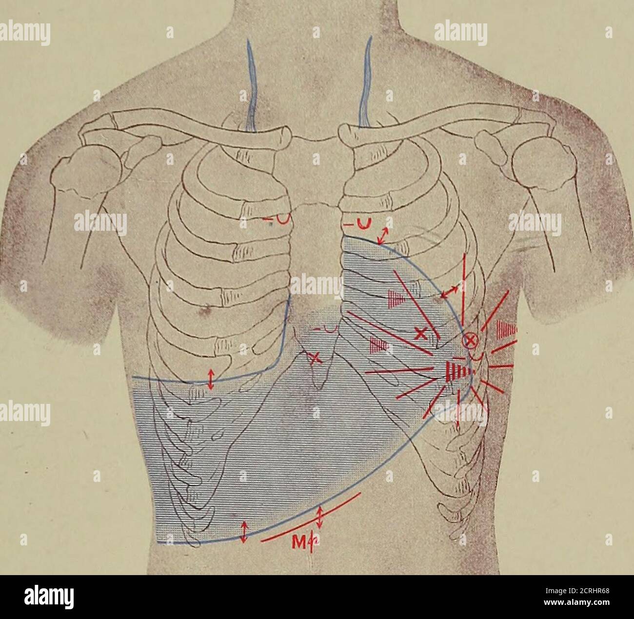Meaning Of Chest Oppression at Indiana Seery blog