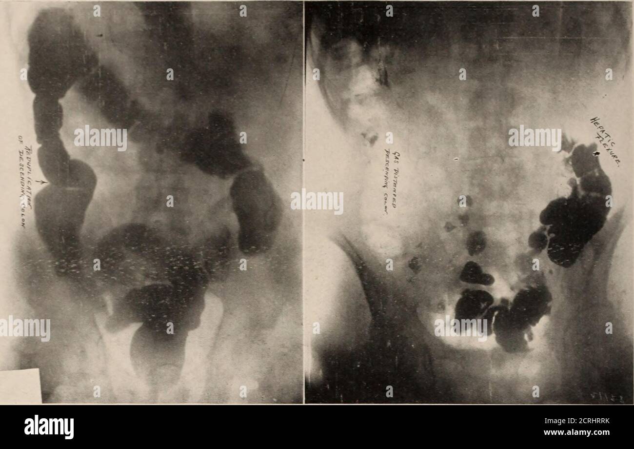 . Journal of radiology . 371 POSITIONAL ANOMALIES OF THE INTESTINAL ...