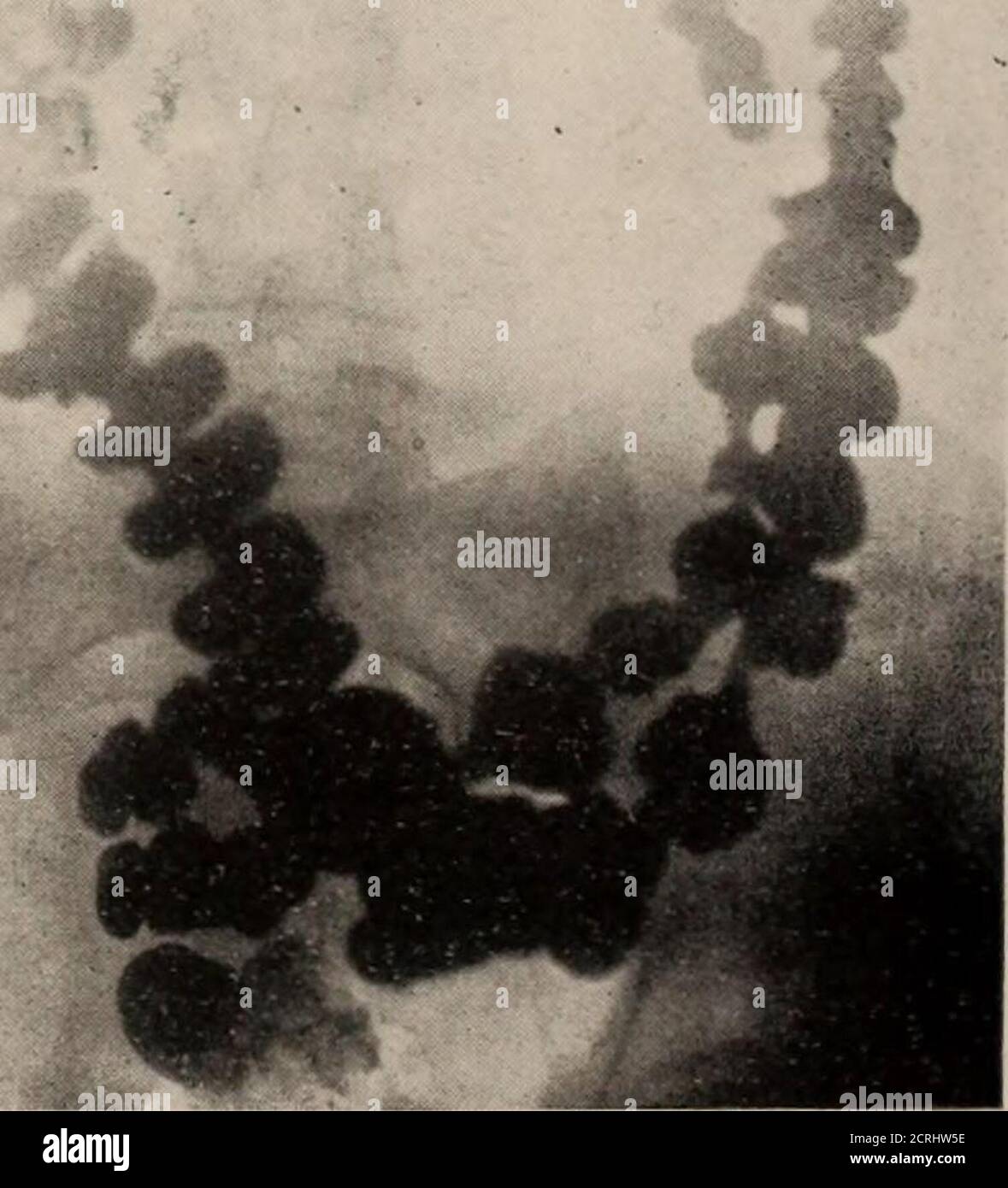 . Journal of radiology . Fig. 16.—Inverted cecum, ascending colon and ...