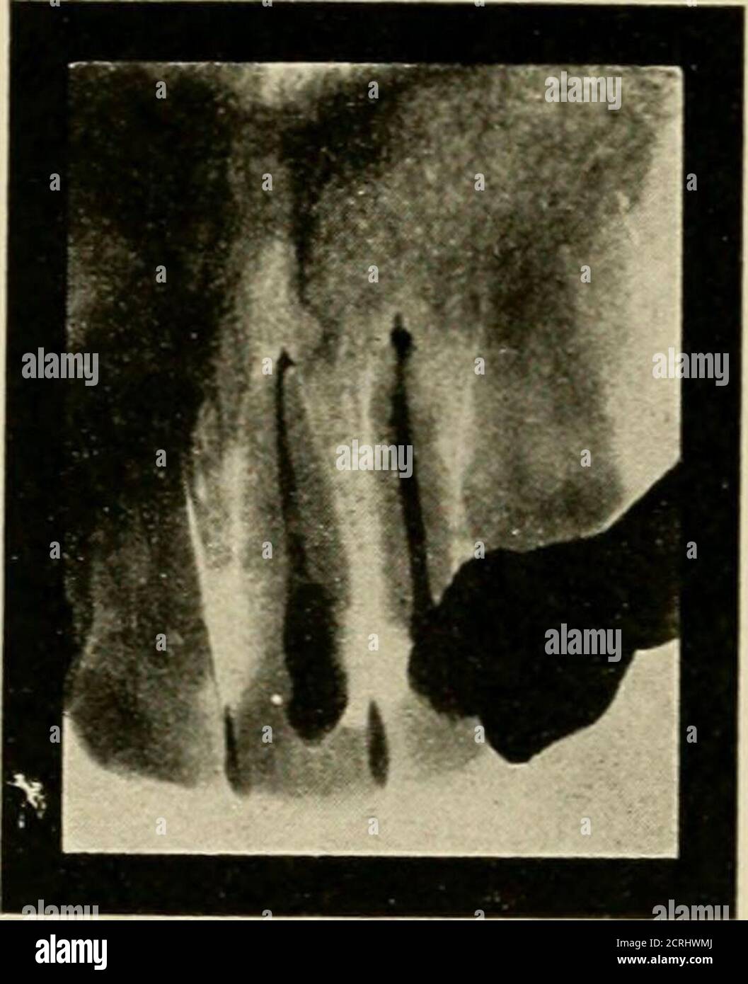 . Elementary and dental radiography / by Howard Riley Raper . Fig. 300 ...