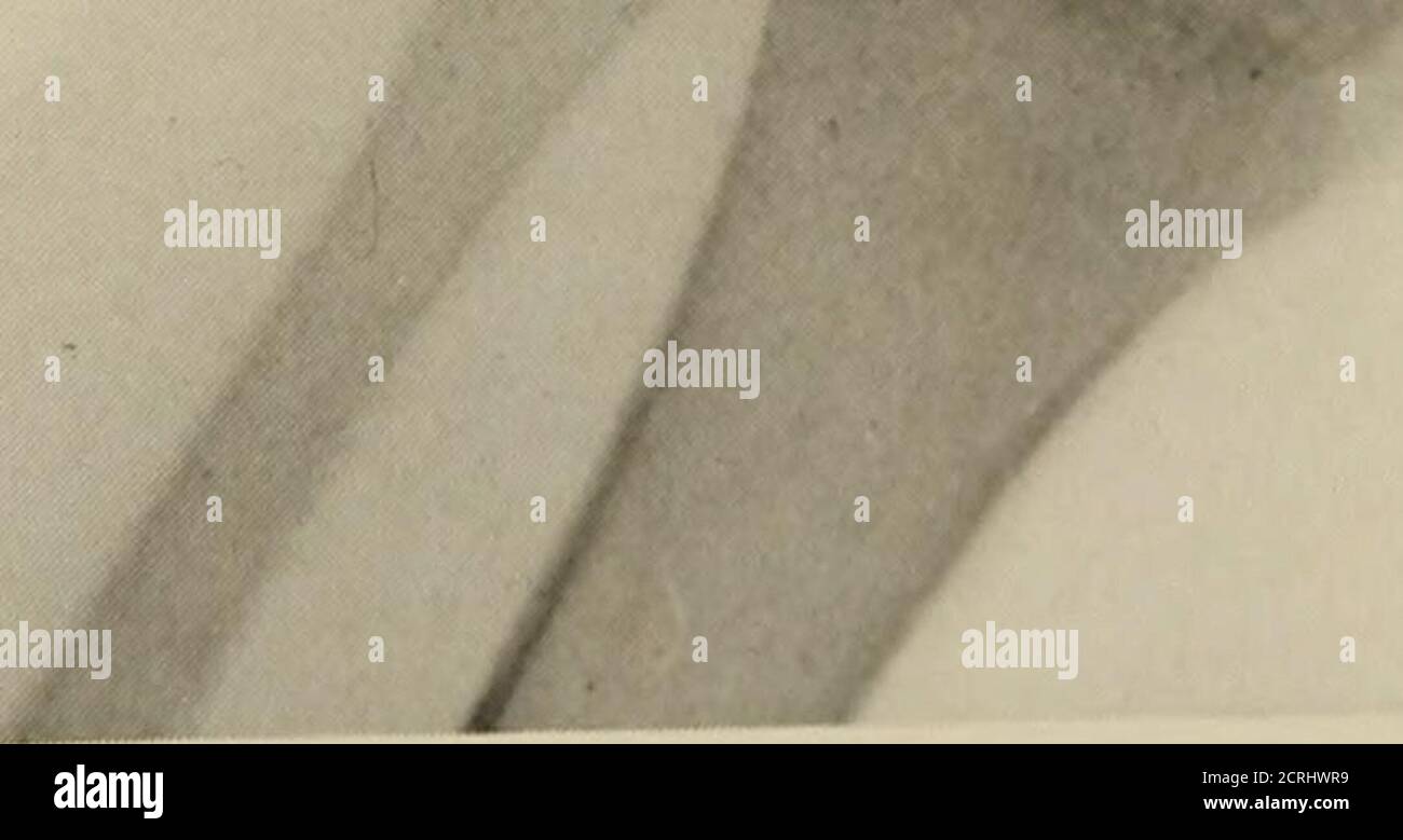 . Living anatomy and pathology; . PLATE 212. THE RESULTS OF AN ACUTE ...