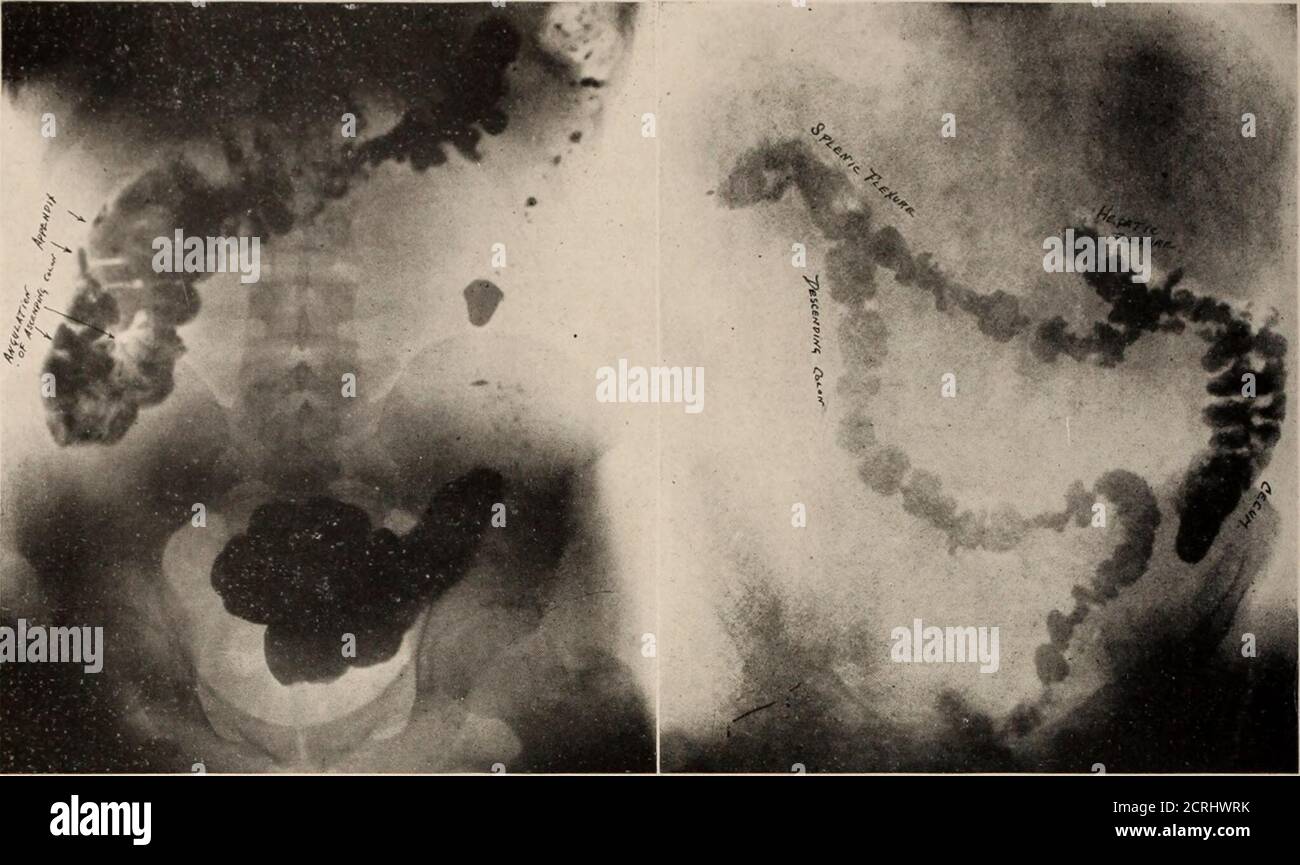 . Journal of radiology . Fig-. 13.—Pelvic colon, situated near level of ...