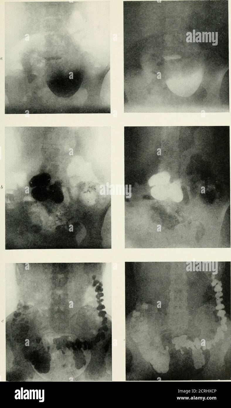 Abdomen x ray normal not lower hi-res stock photography and images - Alamy
