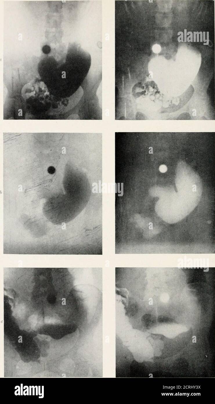 Pyloric stenosis hi-res stock photography and images - Alamy