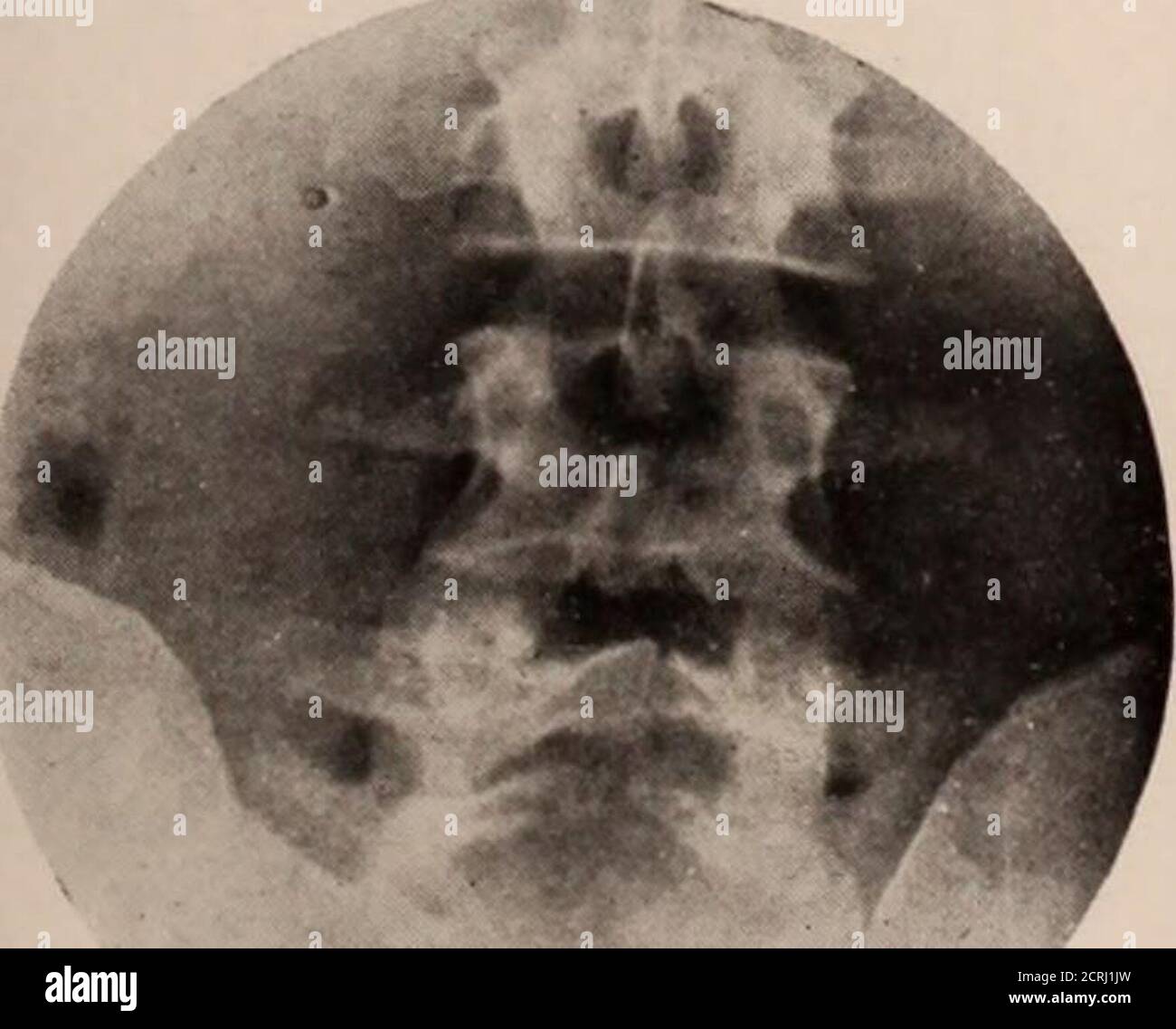 Spina bifida operation hi-res stock photography and images - Alamy