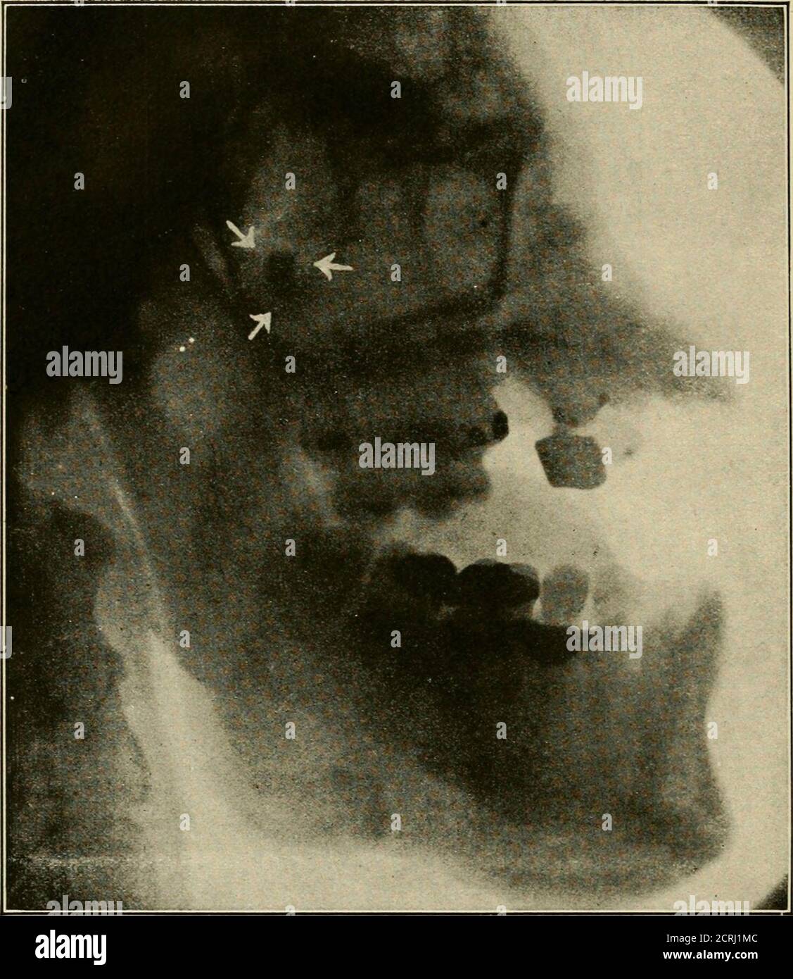 . Elementary and dental radiography / by Howard Riley Raper . Fig. 276 ...