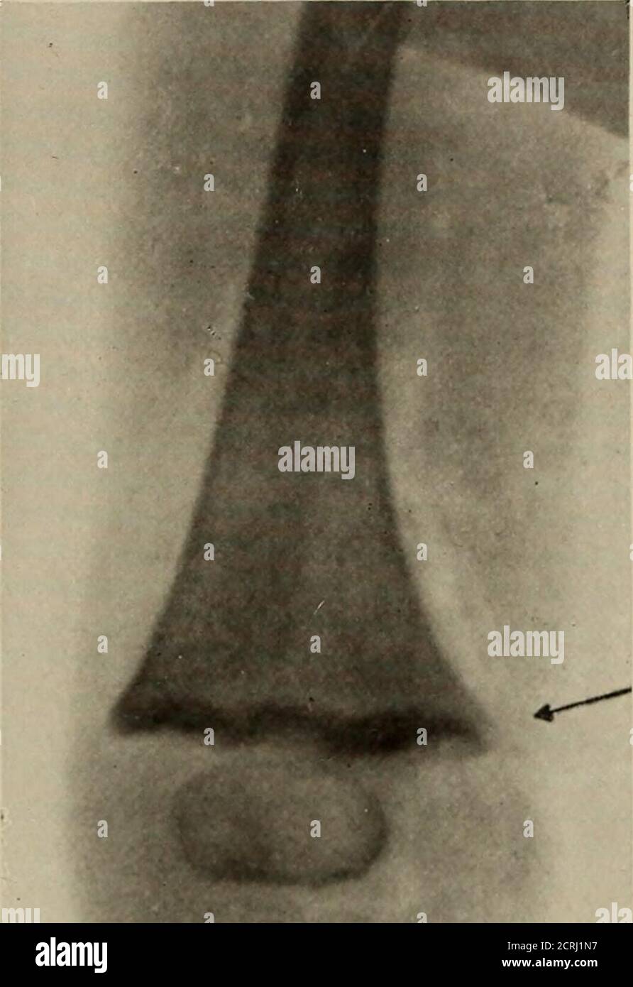 . Living anatomy and pathology; . PLATE 198.EPIPHYSITIS OF THE KNEE ...