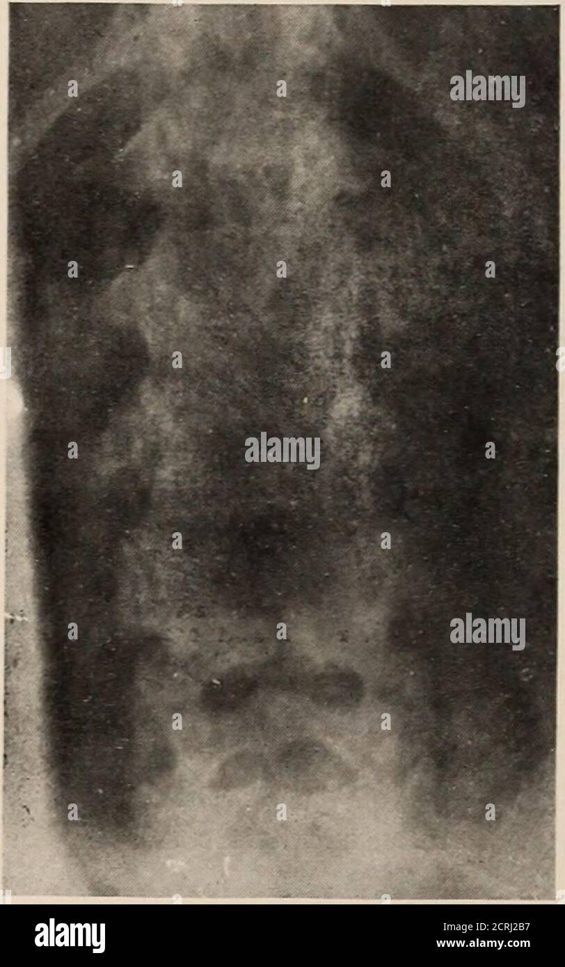 . Journal of radiology . Figs. 18 and 19 (A341129). Spina bi-fida ...