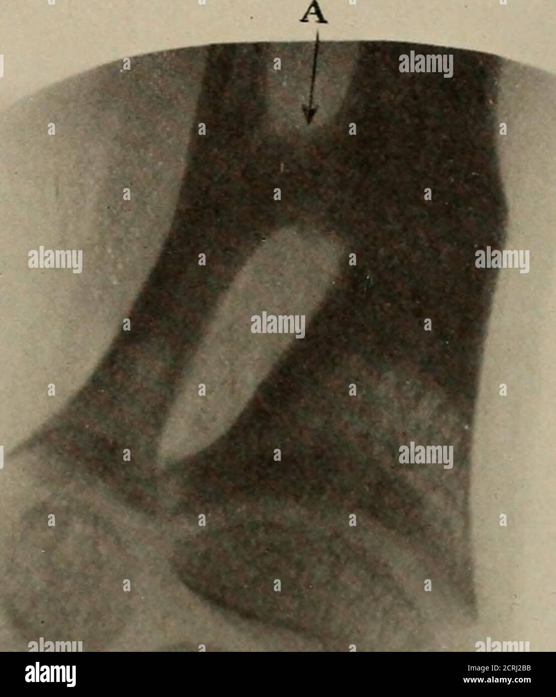 Formation of an abscess hi-res stock photography and images - Alamy