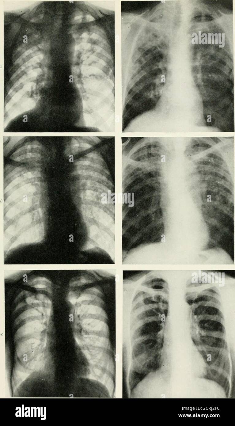 Hypostatic pneumonia hi-res stock photography and images - Alamy