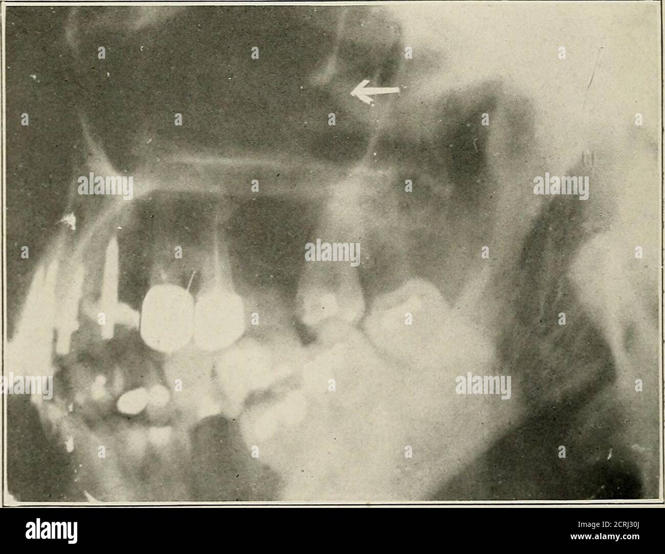 Maxillary first molar hi-res stock photography and images - Alamy