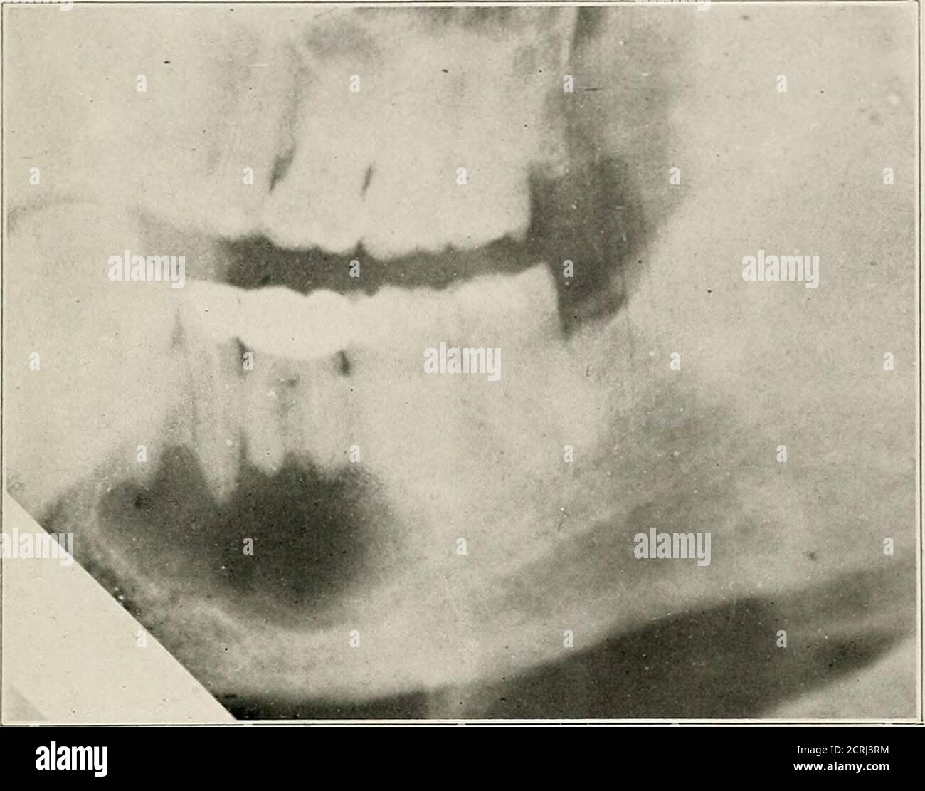 . Interpretation of dental and maxillary roentgenograms . Fig. 242 ...