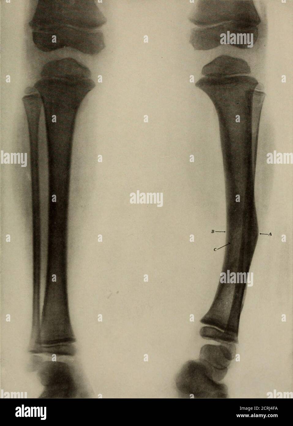 Intracapsular fracture hi-res stock photography and images - Alamy