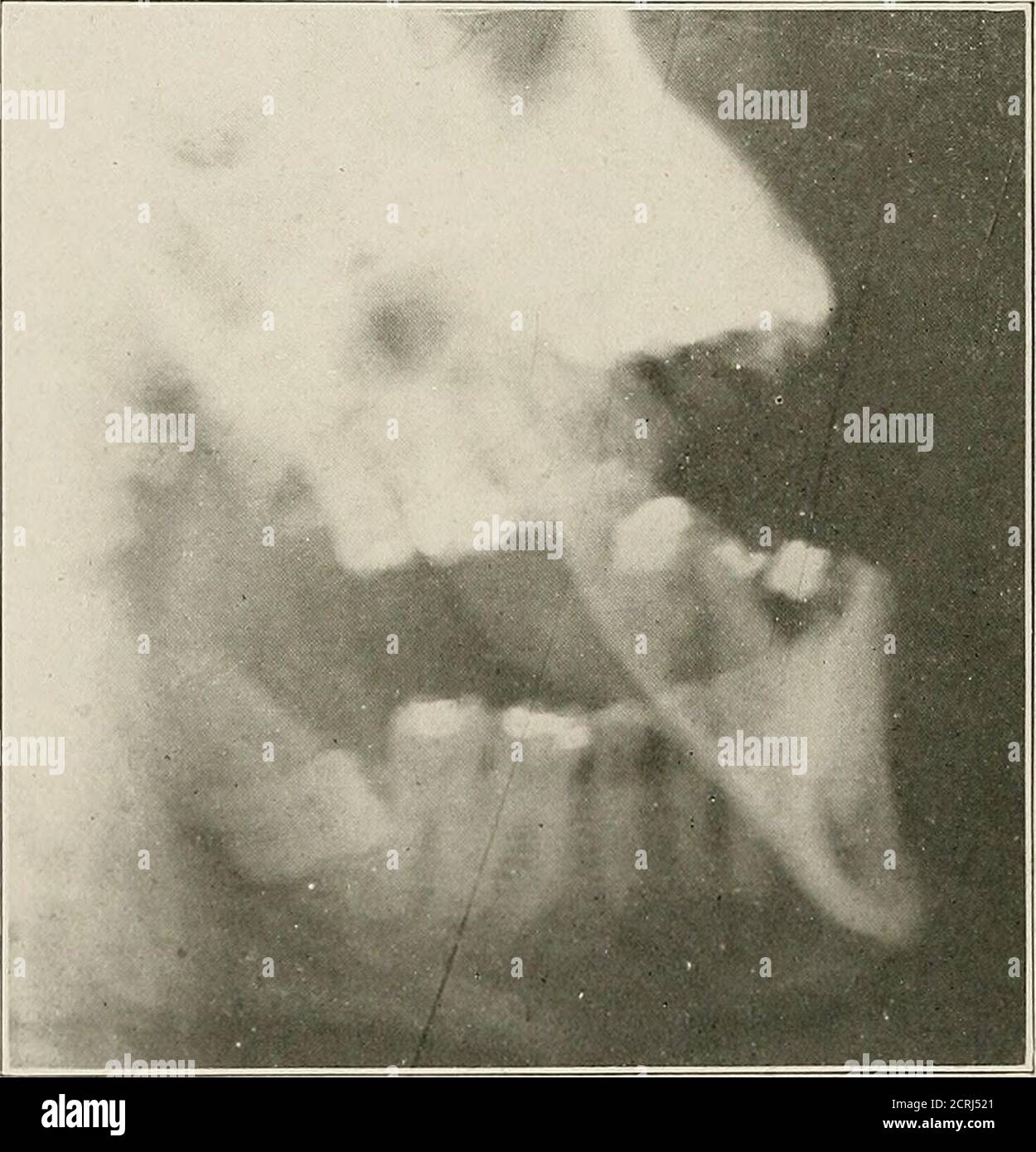 . Interpretation of dental and maxillary roentgenograms . Fig. 233 ...