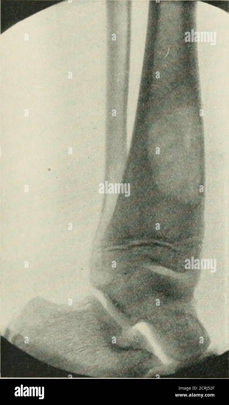 . Radiography, X-ray therapeutics and radium therapy . ce in lung two ...