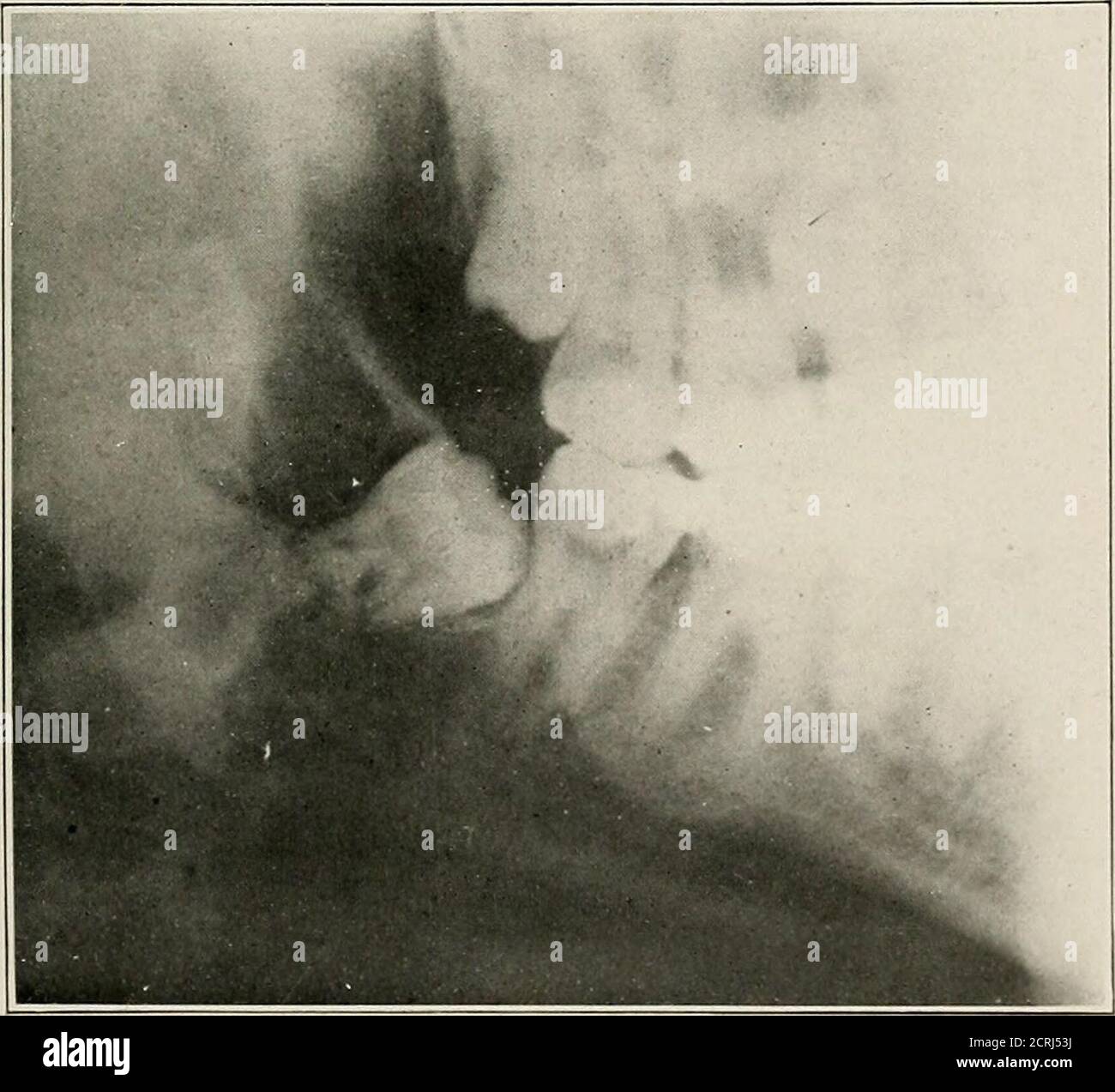 . Interpretation of dental and maxillary roentgenograms . Fig. 235 ...