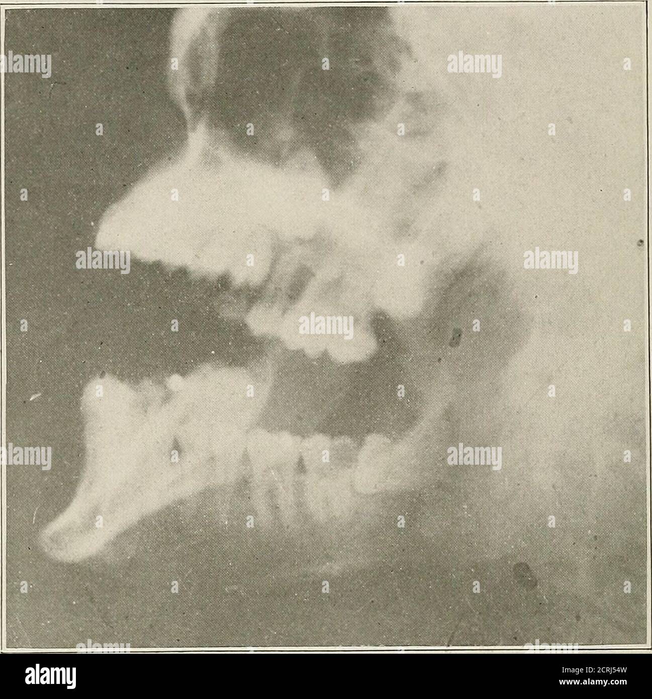 Unerupted third molar hi-res stock photography and images - Alamy