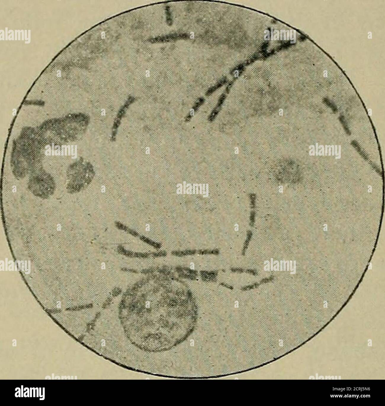 Malignant pustule hi-res stock photography and images - Alamy