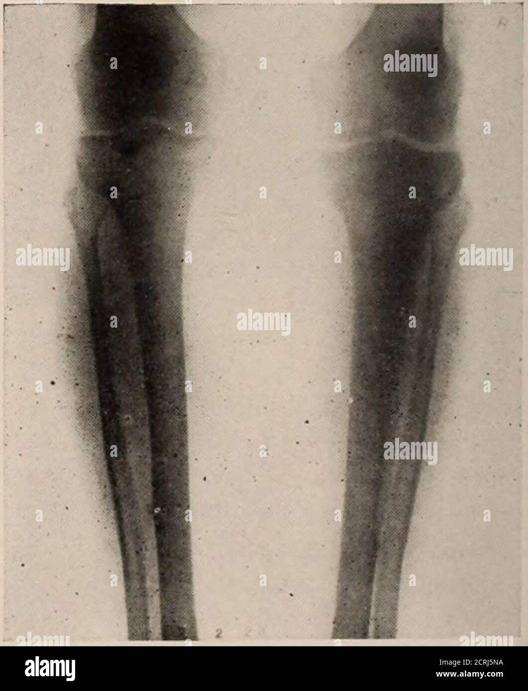 . Journal of radiology . Pathol. No.29616. Multiple infectious ...
