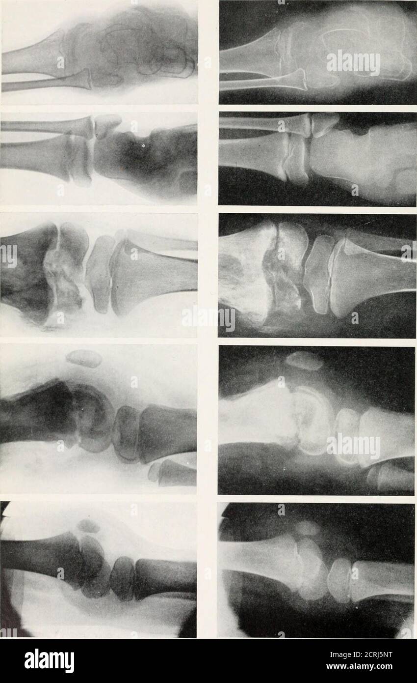 Dactylitis hi-res stock photography and images - Alamy