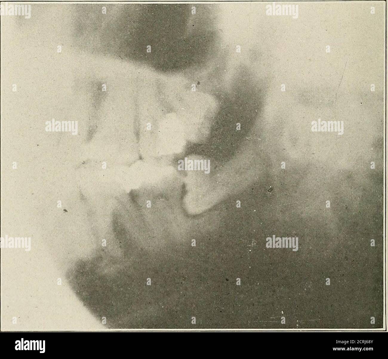. Interpretation of dental and maxillary roentgenograms . Fig. 230 ...