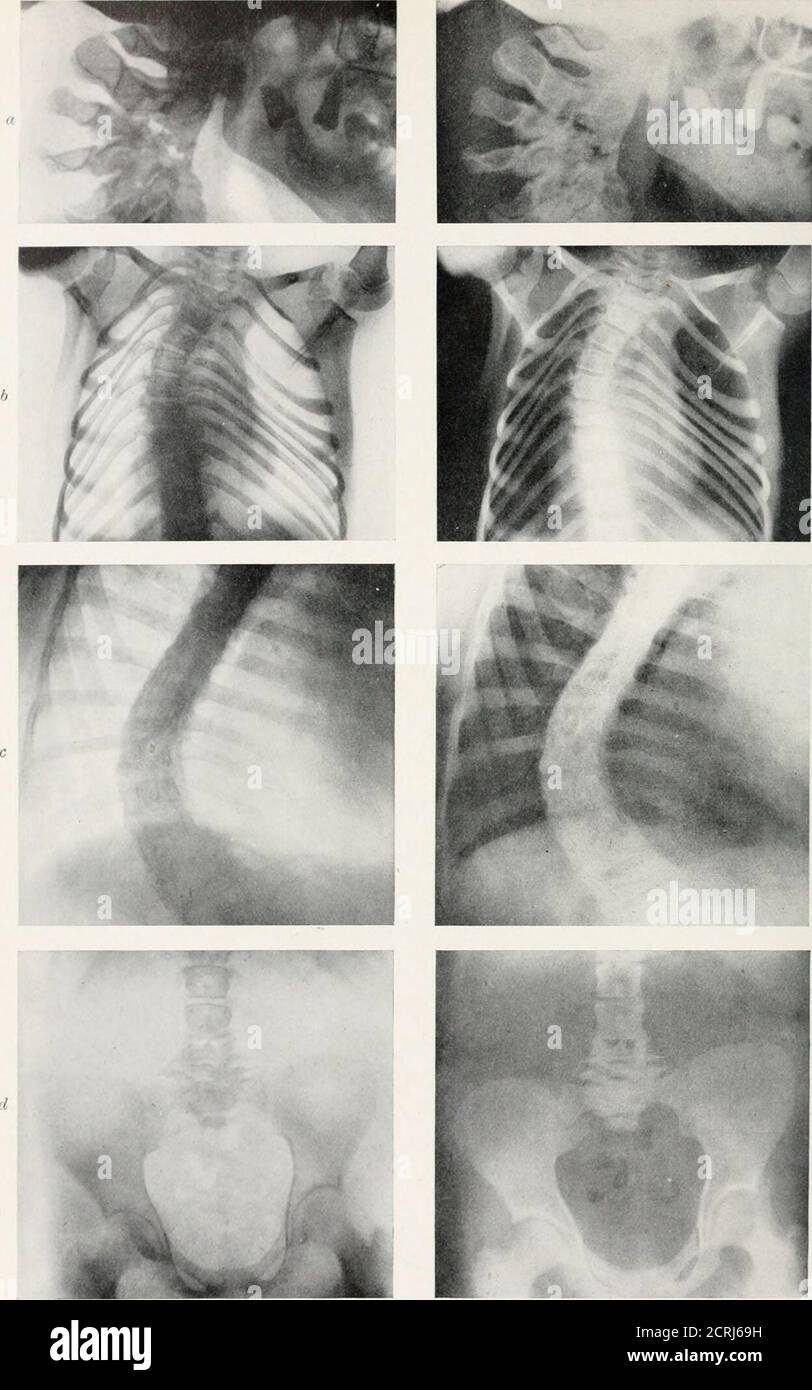 Foreign bodies x ray hi-res stock photography and images - Alamy