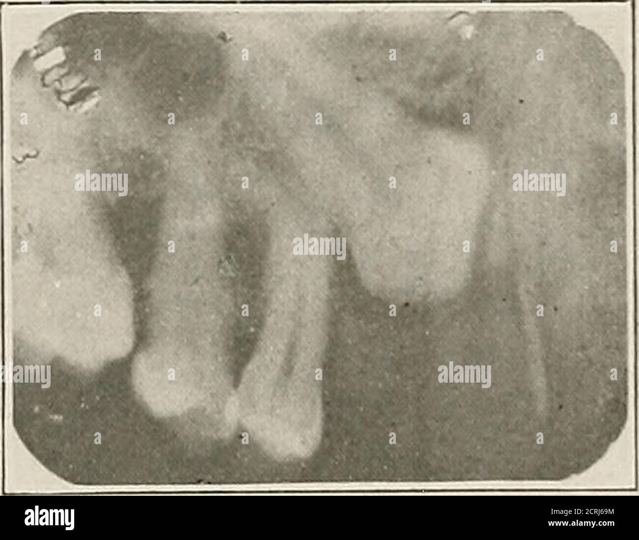 . Interpretation of dental and maxillary roentgenograms . Fig. 228 ...