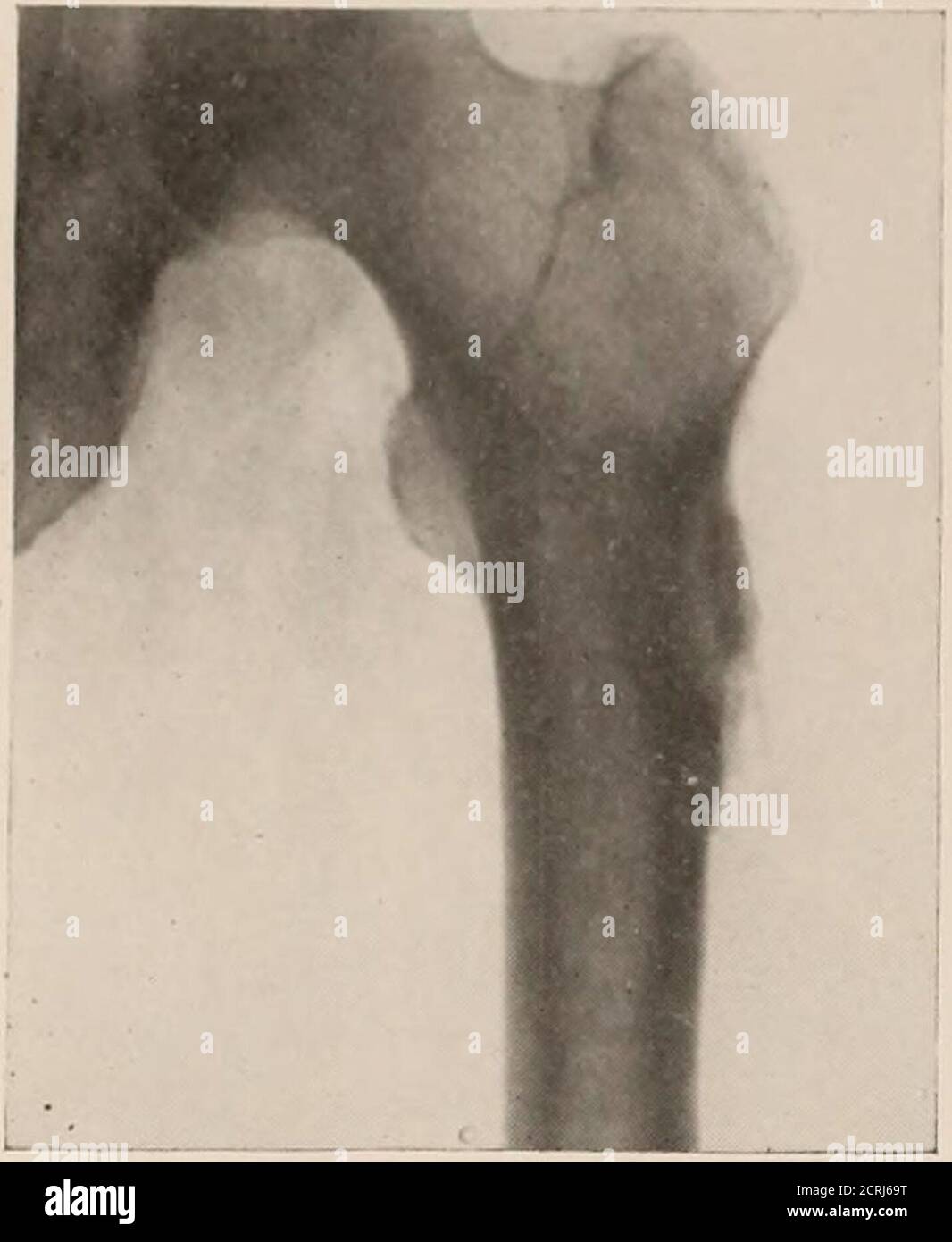 . Journal of radiology . Figure Xl.-a—Case VI.—Pathol. No.29019 ...
