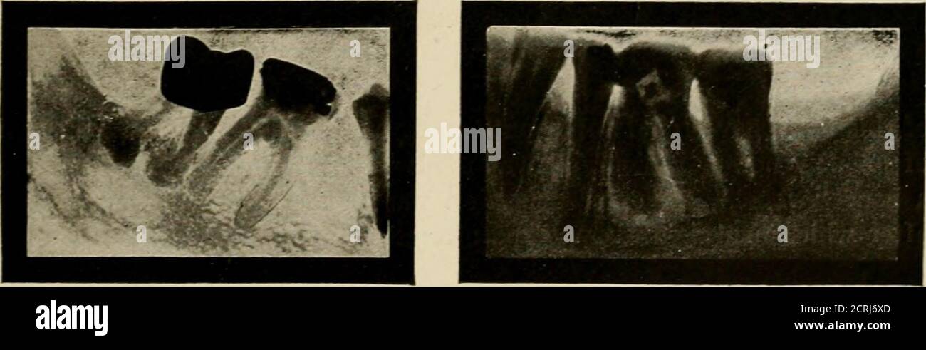 Cementoma High Resolution Stock Photography and Images - Alamy