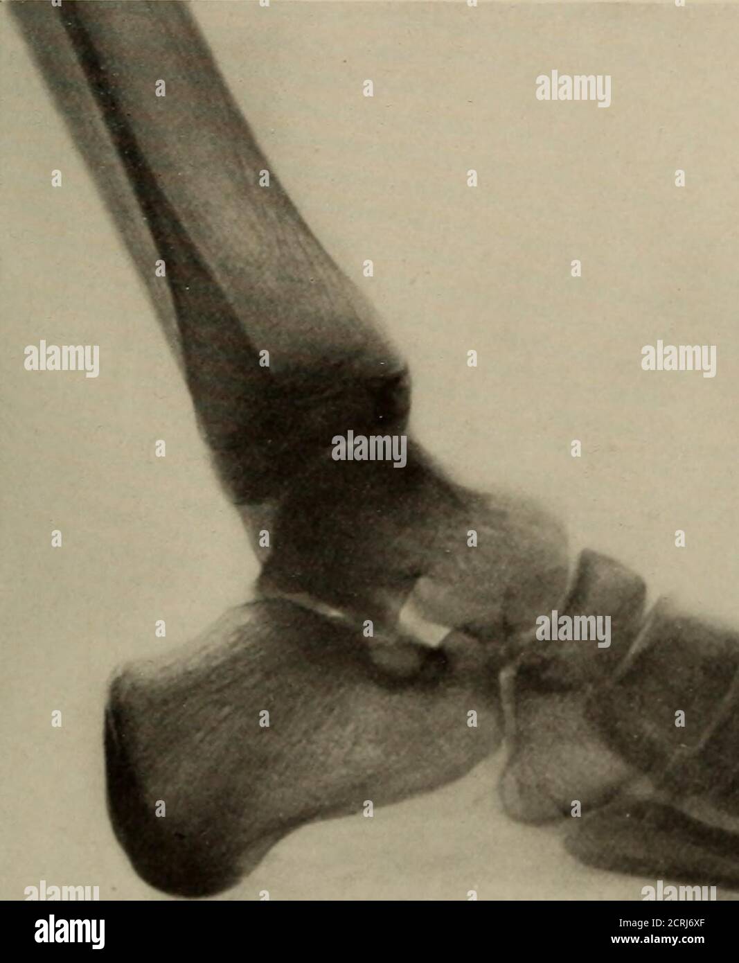 . Living anatomy and pathology; . PLATE 178.MODERATE FLAT-FOOT. Girl ...