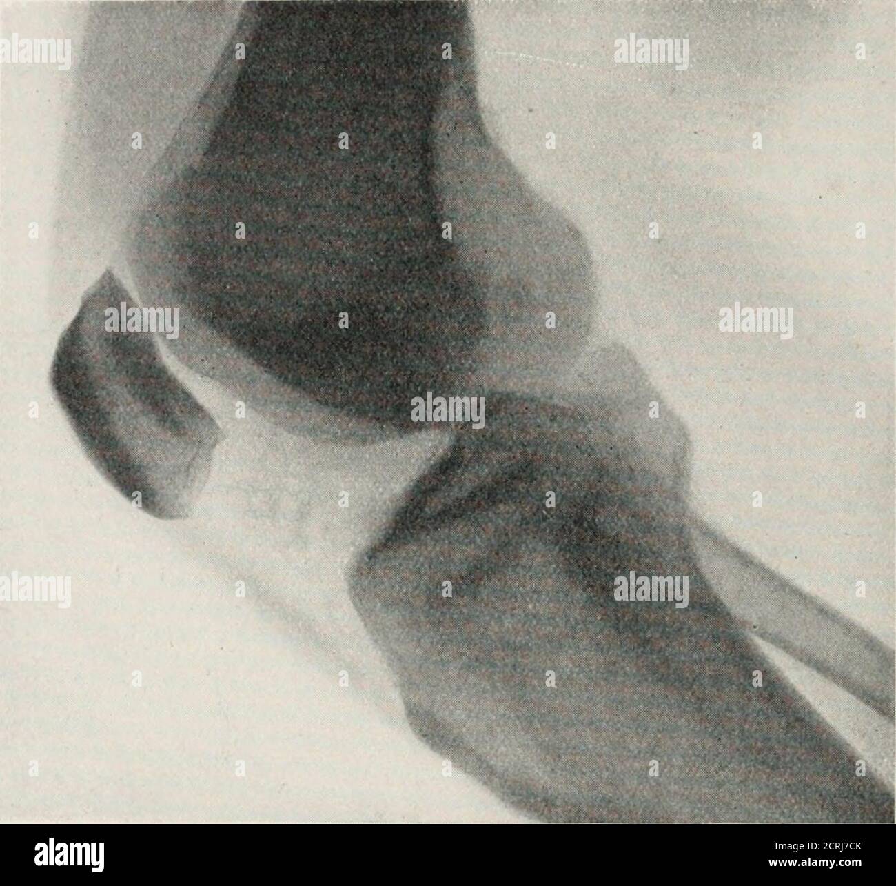 Formation of an abscess hi-res stock photography and images - Alamy