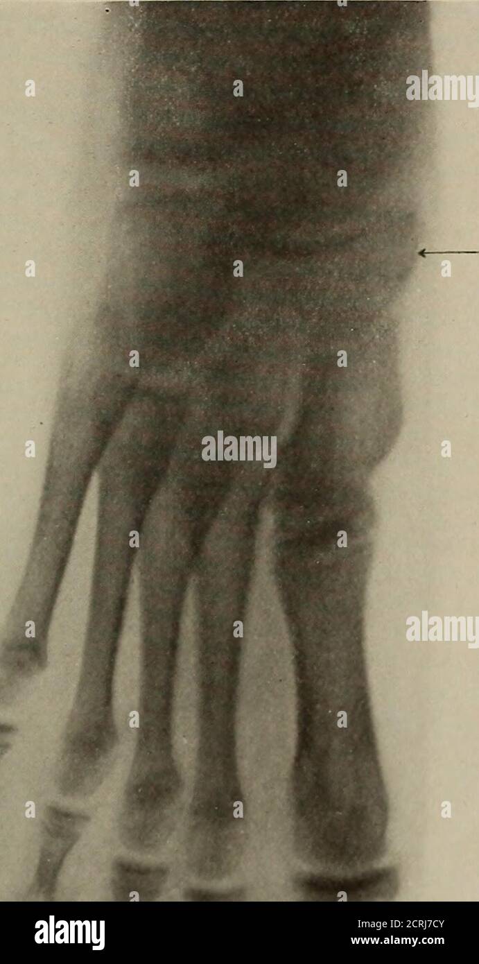 . Living anatomy and pathology; . , l! PLATE 176.CALLUSES OF FEET. Girl ...