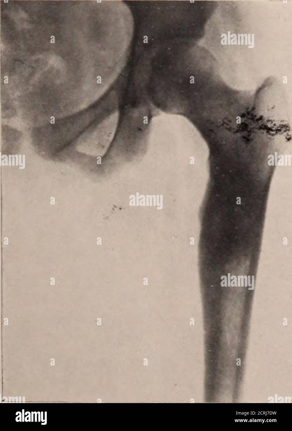 . Journal of radiology . Figure VI.—Case II.—Pathol. No.28771 ...