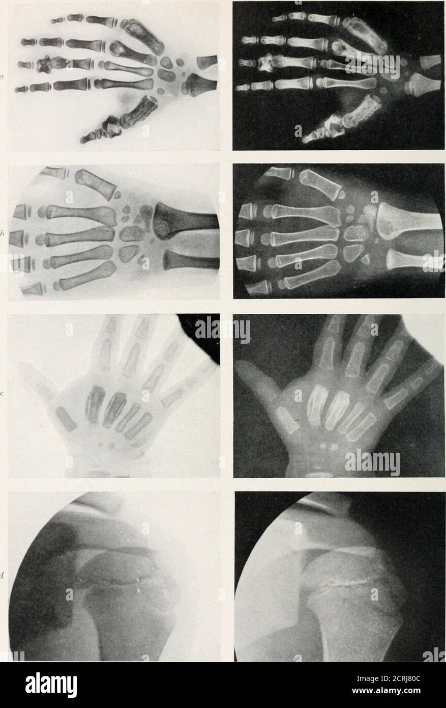 Radiography, X-ray therapeutics and radium therapy . PLATE .Y ...