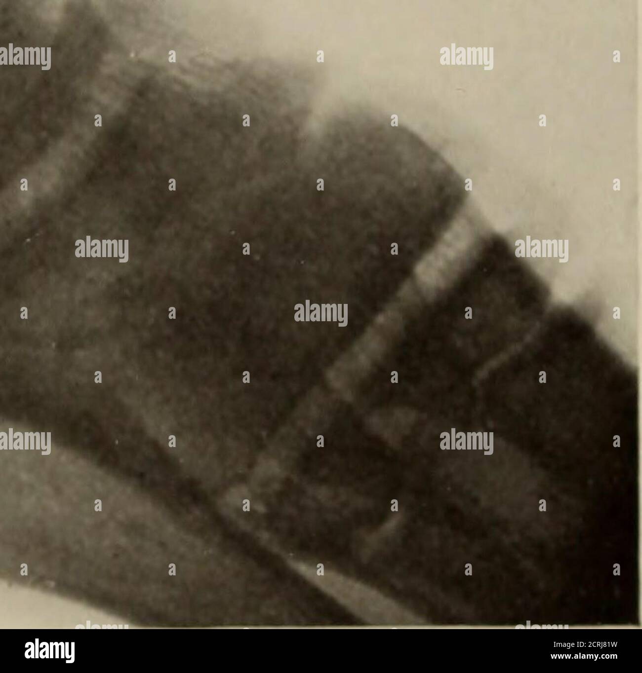 . Living anatomy and pathology; . PLATE 172.MULTIPLE EXOSTOSES OF TIBIA ...