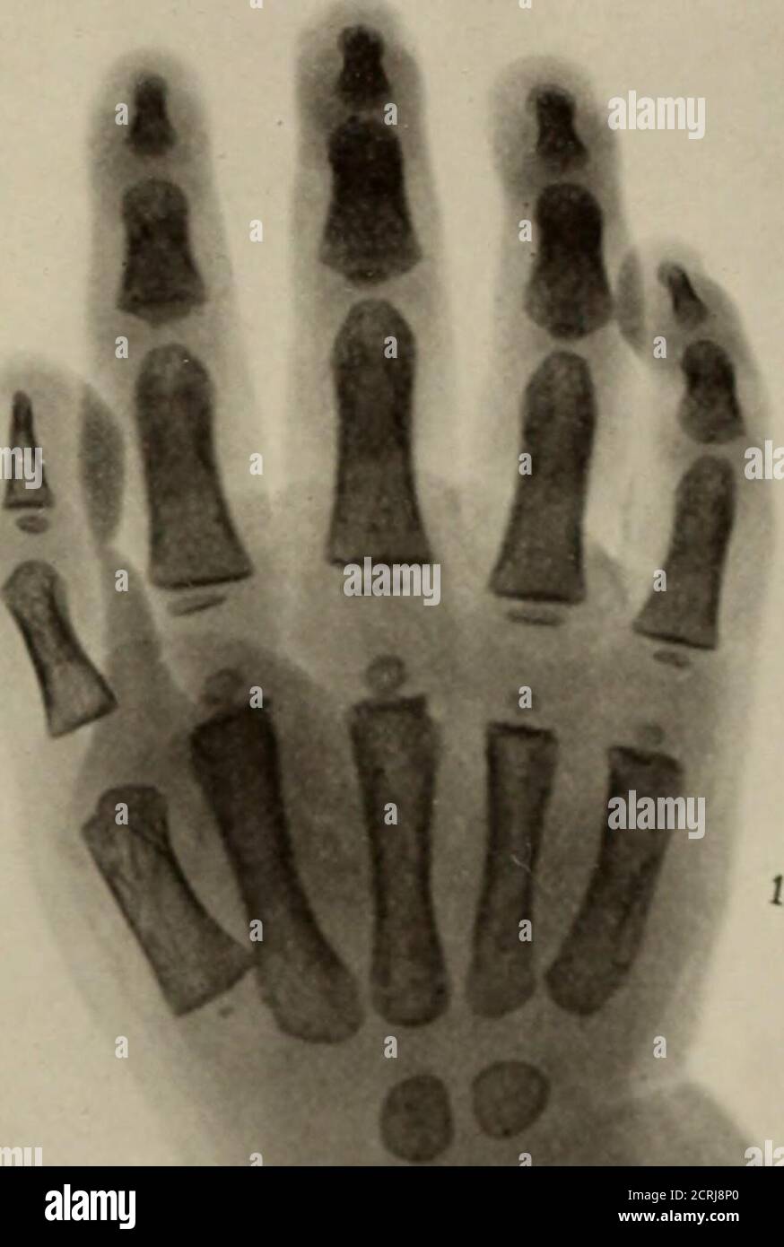 . Living anatomy and pathology; . i PLATE 167.ANTERIOR POLIOMYELITIS OF ...