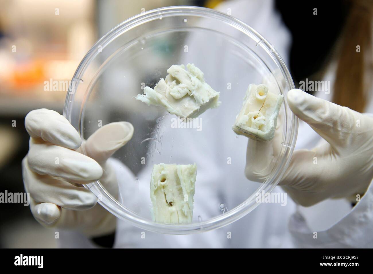 Bone Graft High Resolution Stock Photography and Images - Alamy