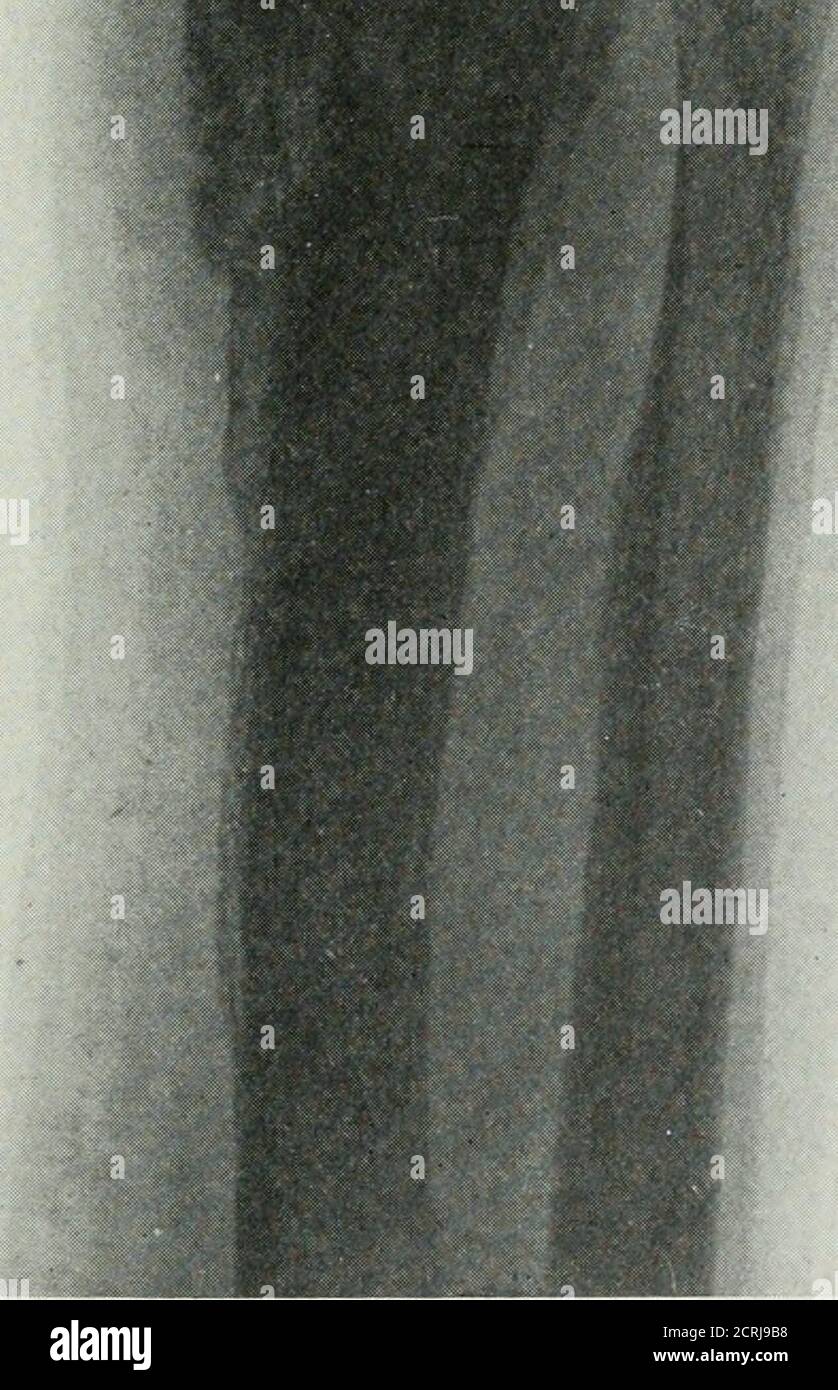 . The Roentgen rays in medicine and surgery as an aid in diagnosis and ...