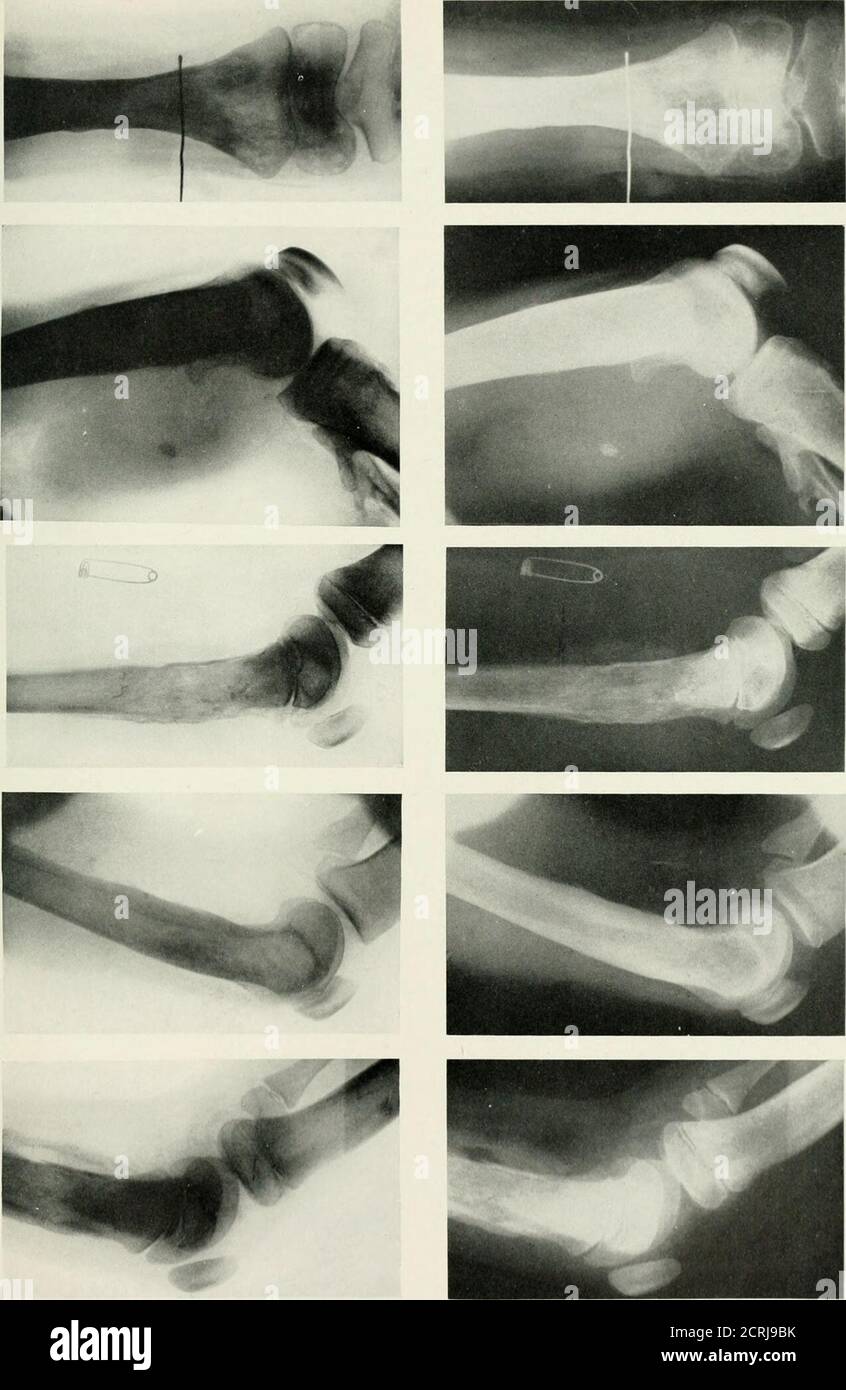 Tuberculous dactylitis hi-res stock photography and images - Alamy
