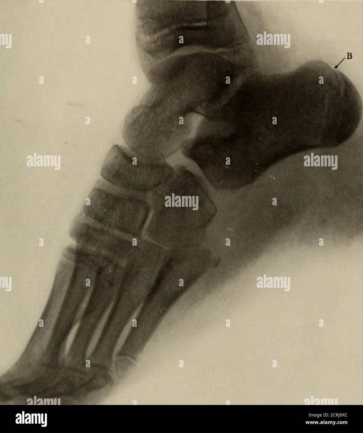 . Living anatomy and pathology; . PLATE 162.HEMATOMA OF HEEL. Child ...