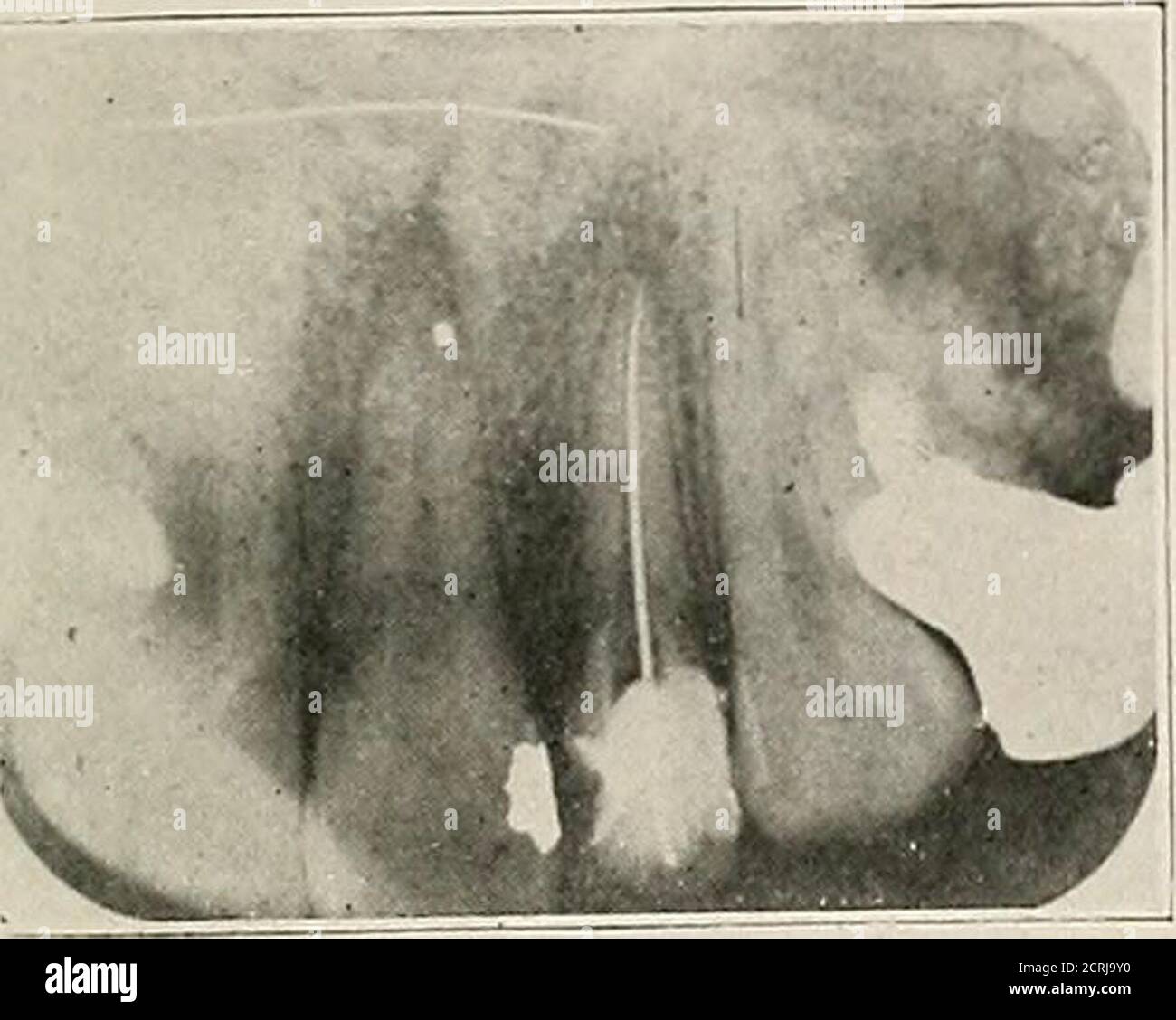 . Interpretation of dental and maxillary roentgenograms . Fig. 213.—A ...