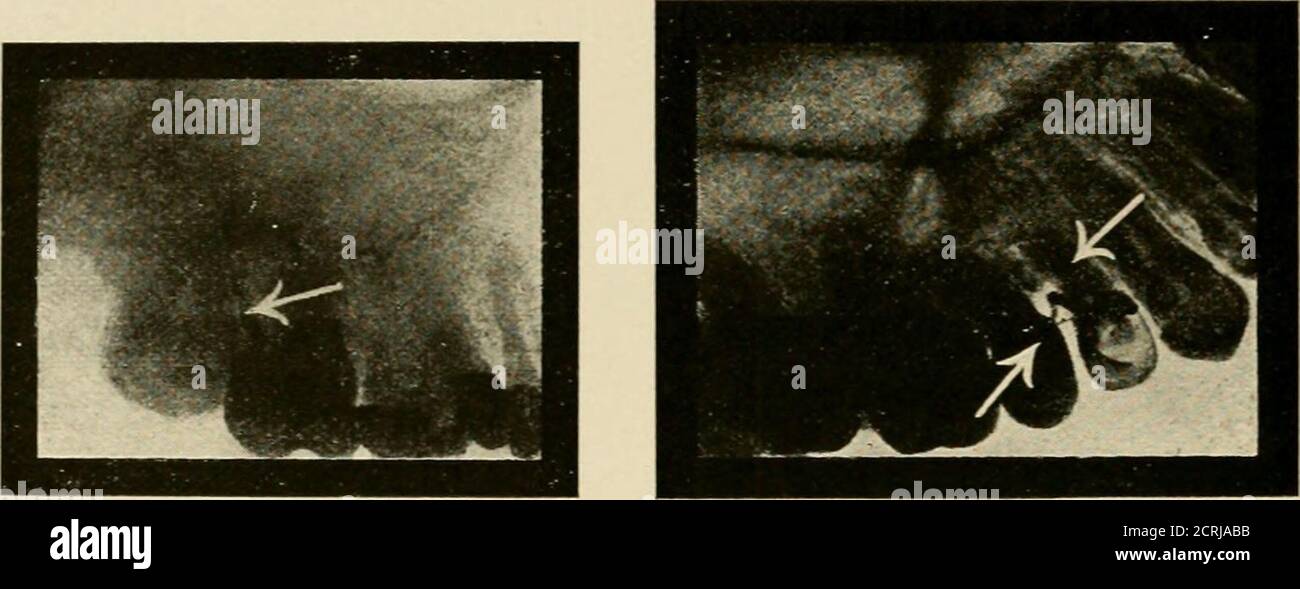 The bone raper hi-res stock photography and images - Alamy