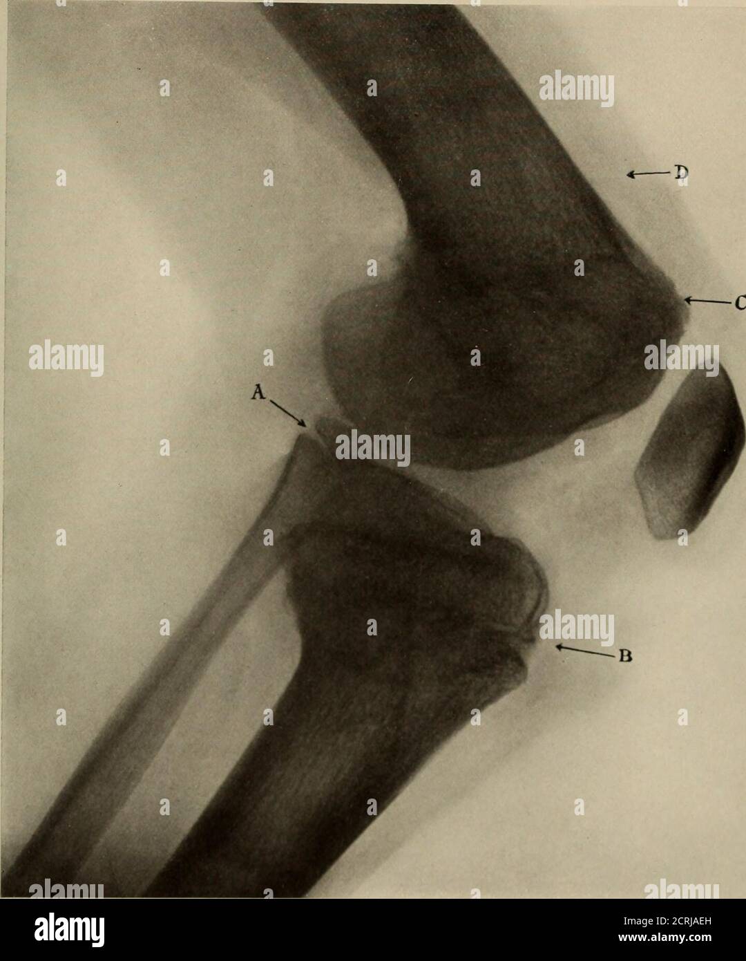 . Living anatomy and pathology; . PLATE 160. EARLY OSSIFICATION OF THE ...