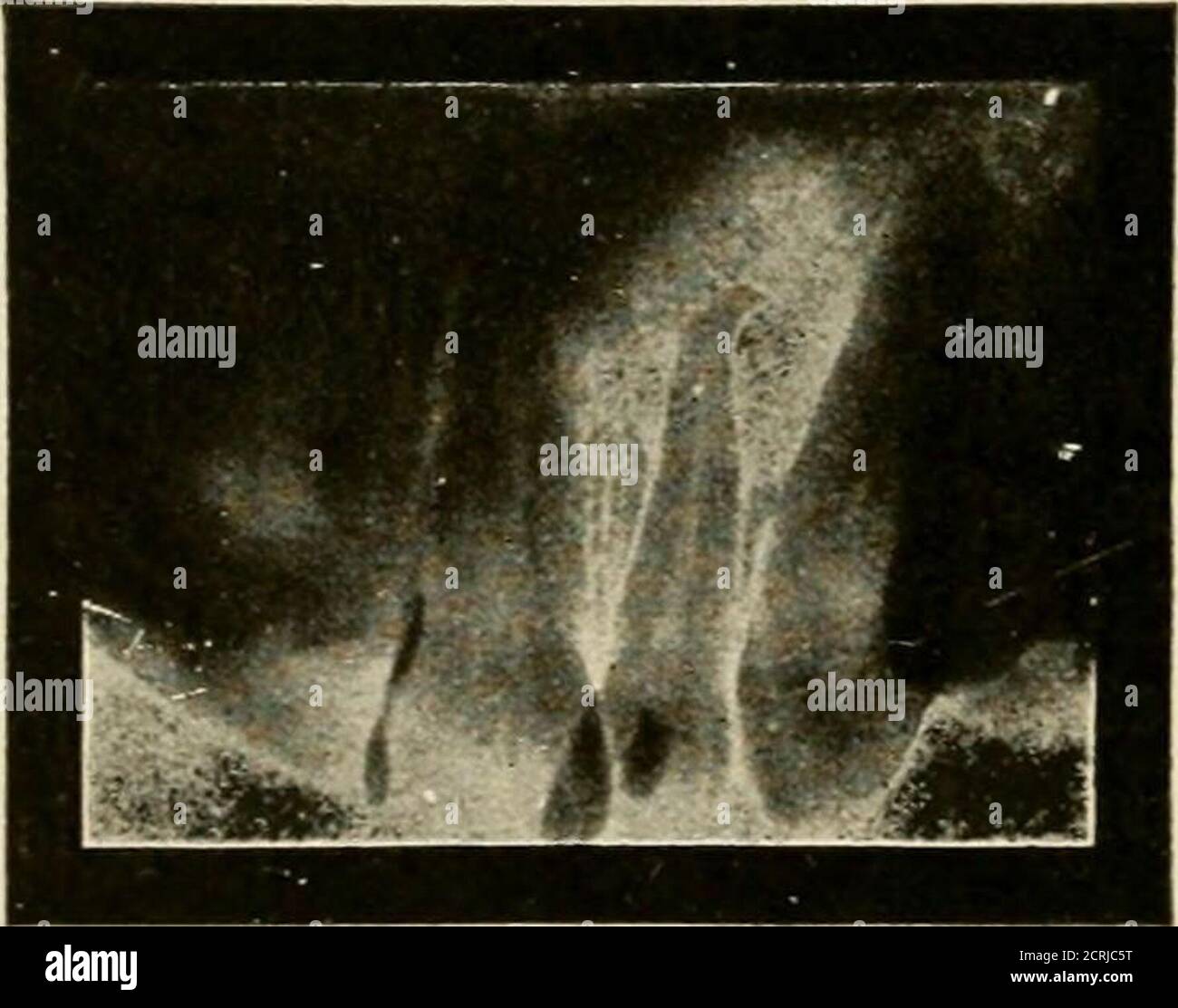Alveolar abscess hi-res stock photography and images - Alamy
