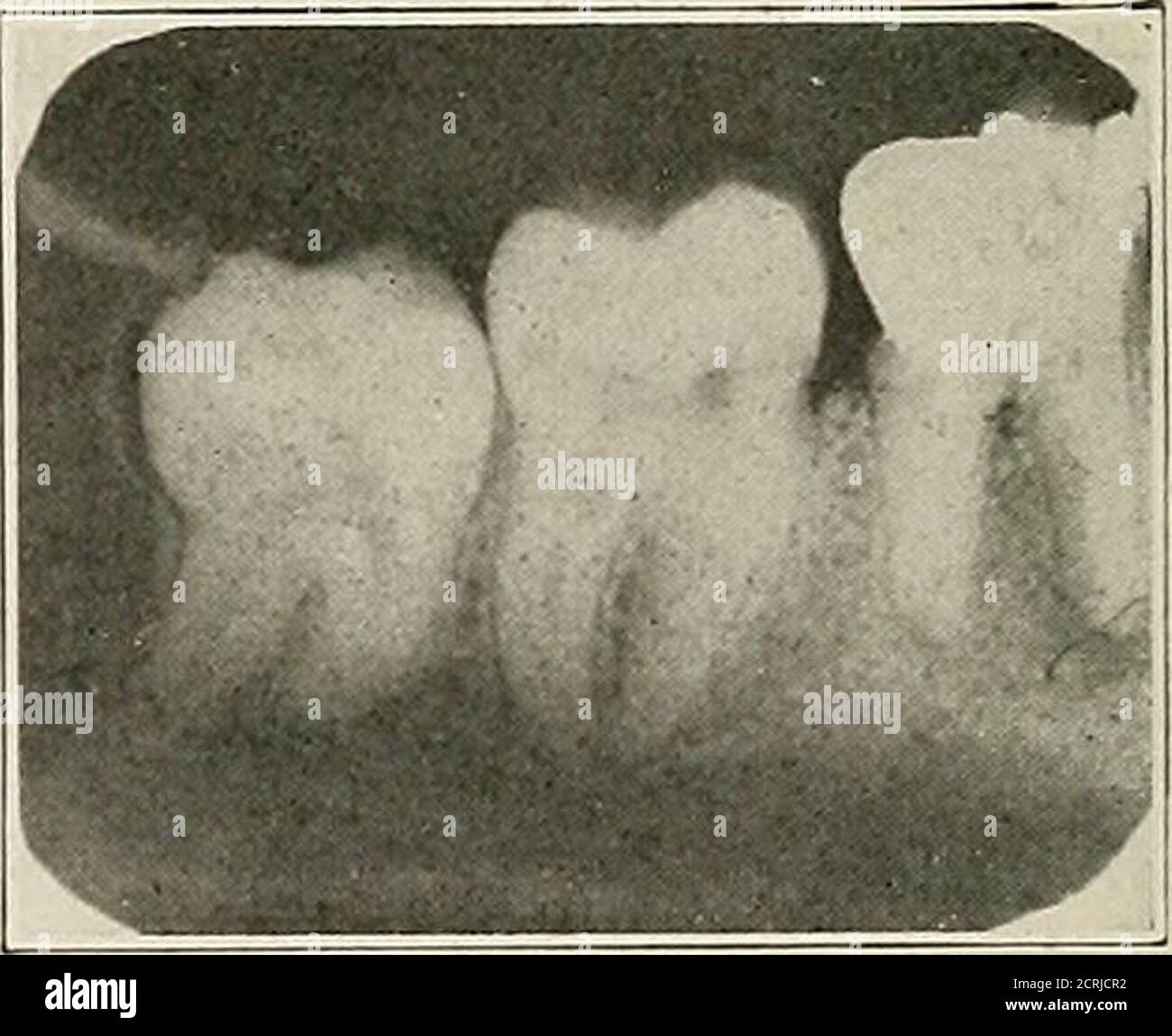 Periapical x ray hi-res stock photography and images - Alamy