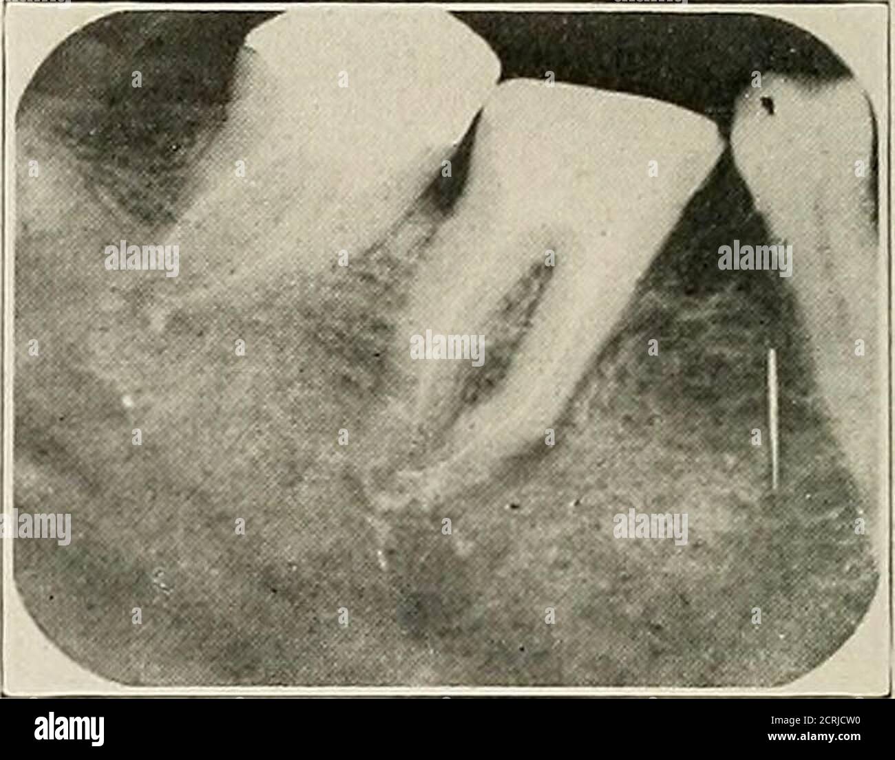 . Interpretation of dental and maxillary roentgenograms . Fig. 202. Fig ...