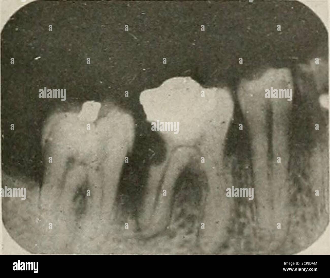 Maxillary Osteitis at Emma Frazier blog