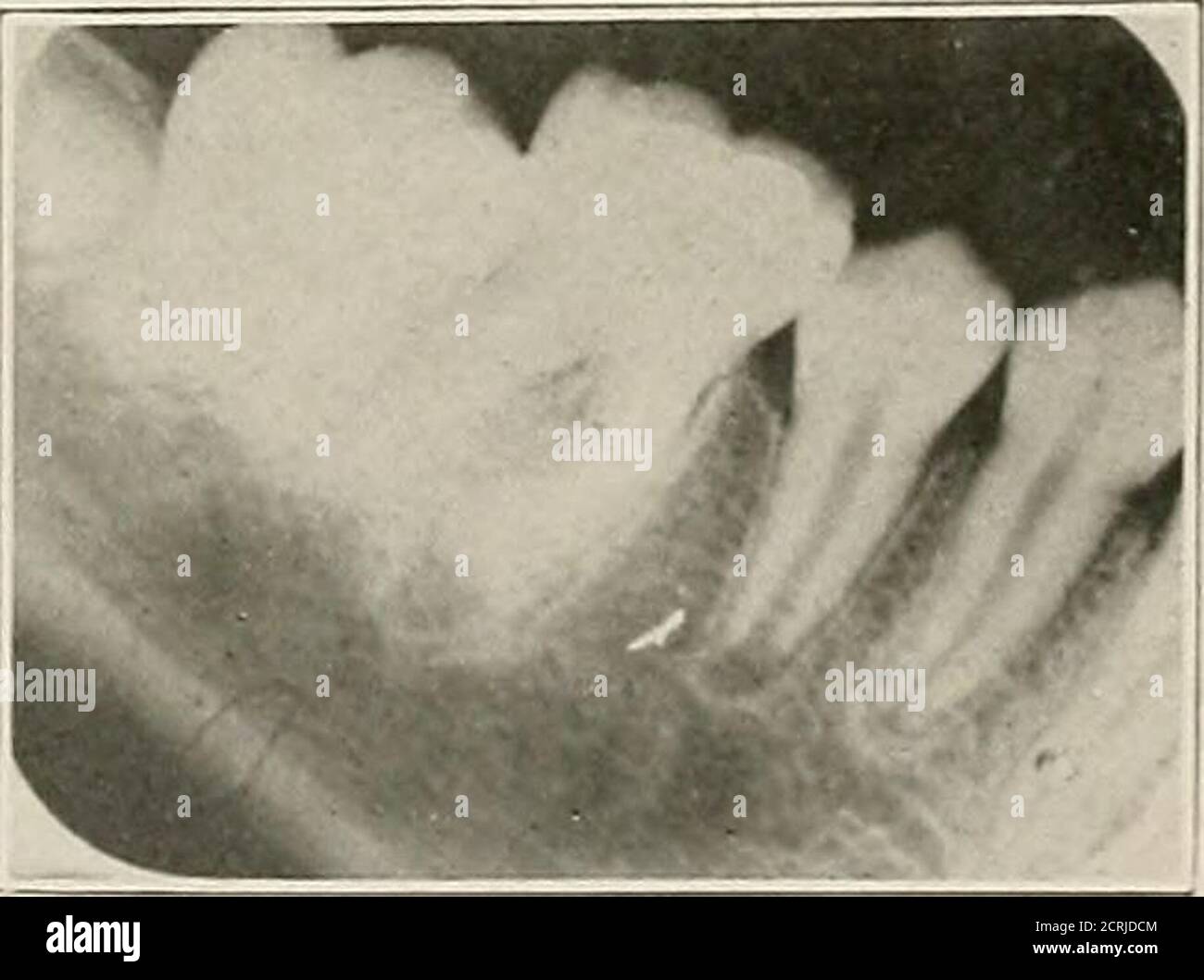 . Interpretation of dental and maxillary roentgenograms . Fig. 200. Fig ...